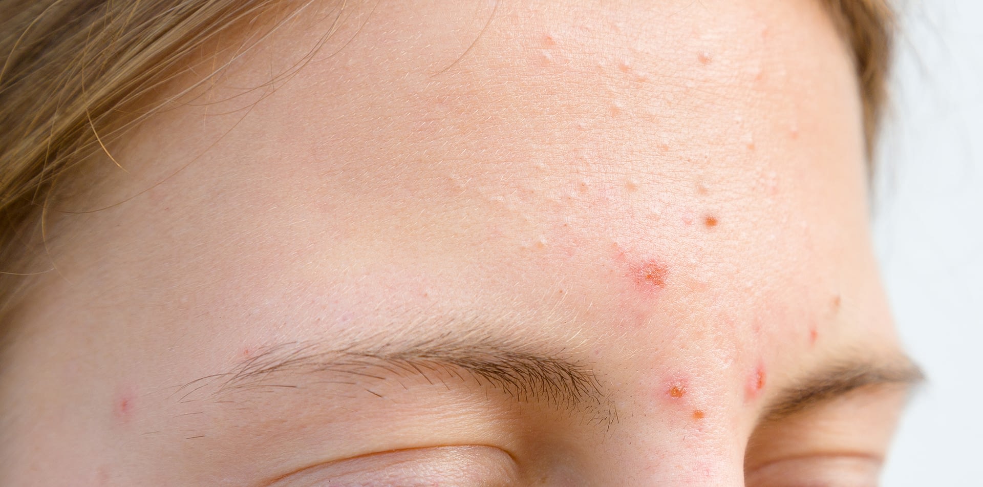 Acne - Skin Clinics