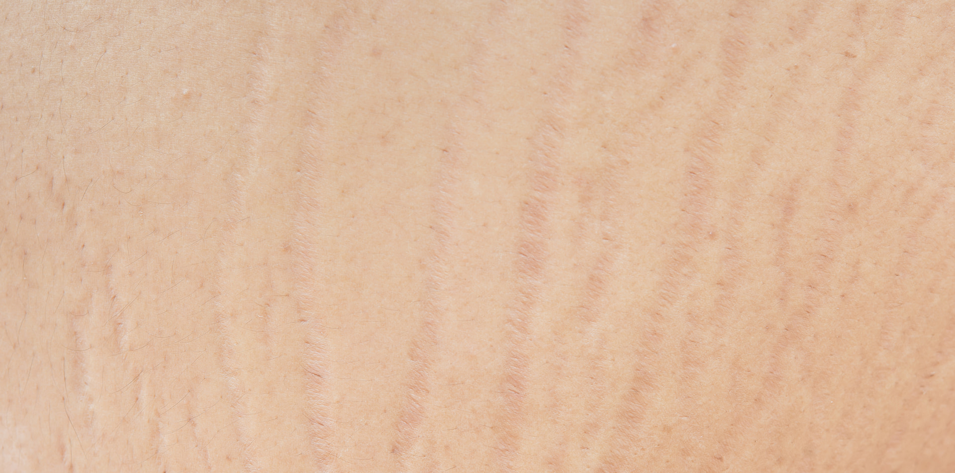 Stretch Marks - Skin Clinics